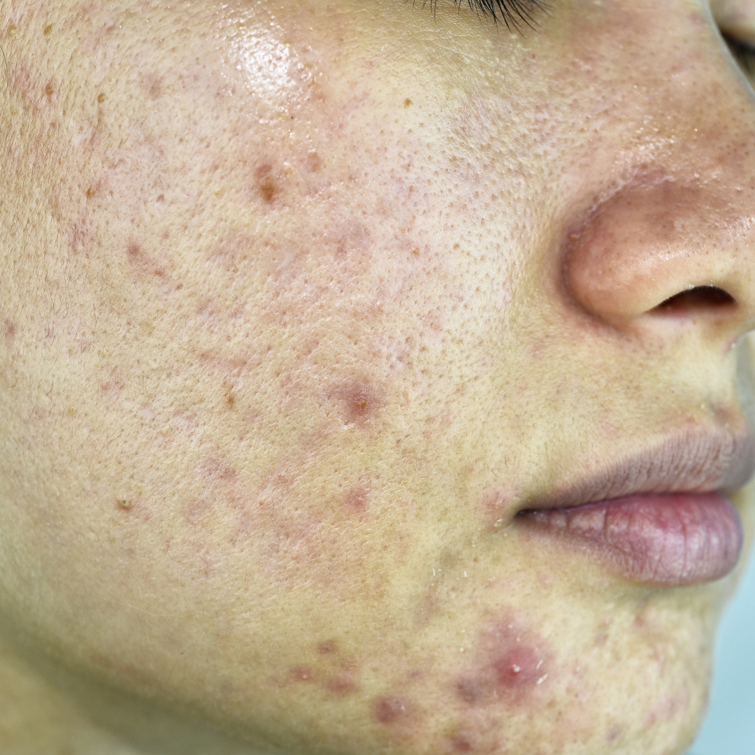 Navigating The Clean Skincare Landscape For Acne: A Comprehensive Guide ... Navigating The Clean Skincare Landscape For Acne: A Comprehensive Guide ...